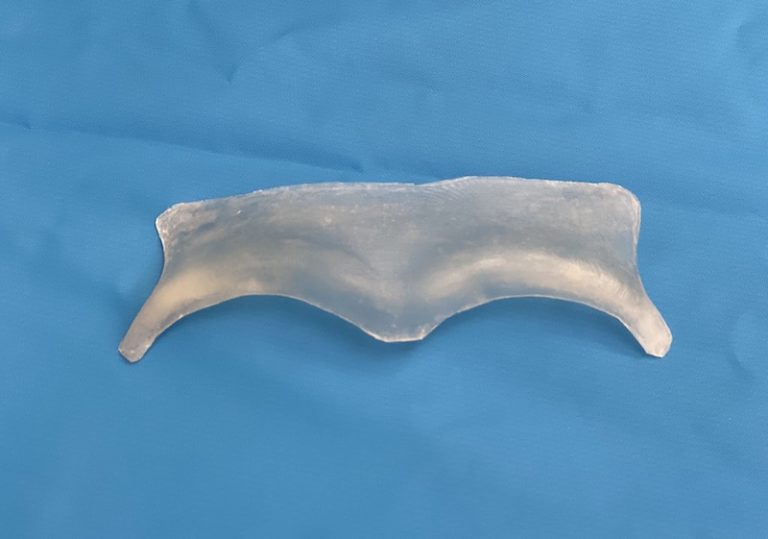 Custom Brow Bone Implant Designs Based On Anatomic Brow Bone Topography ...