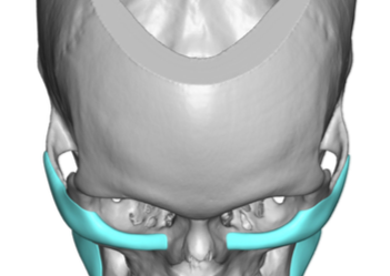 male custom infraorbital-malar implan design top view Dr Barry Eppley ...