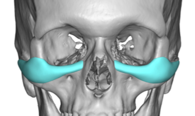 male custom infraorbital-malar implant design front view Dr Barry ...