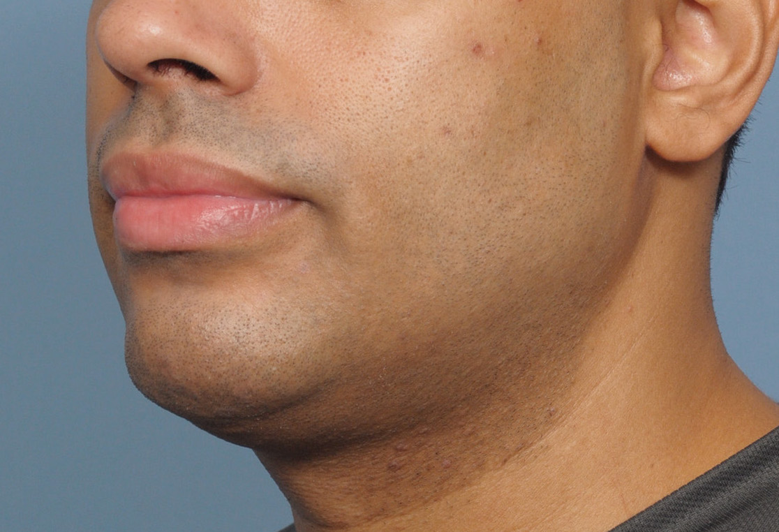 male lower facial deficiency oblique view Dr Barry Eppley Indianapolis ...