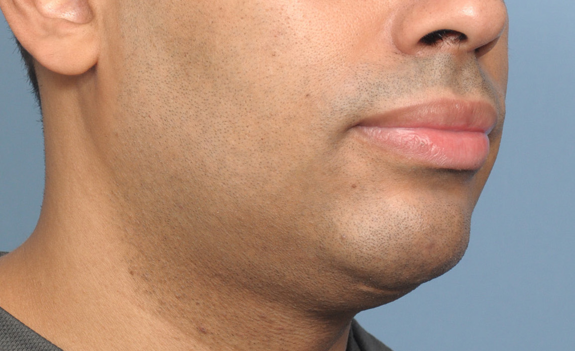 Plastic Surgery Case Study - An Autologous-Implant Approach to Jawline ...