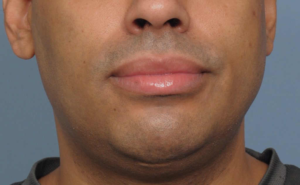 Plastic Surgery Case Study - An Autologous-Implant Approach to Jawline ...