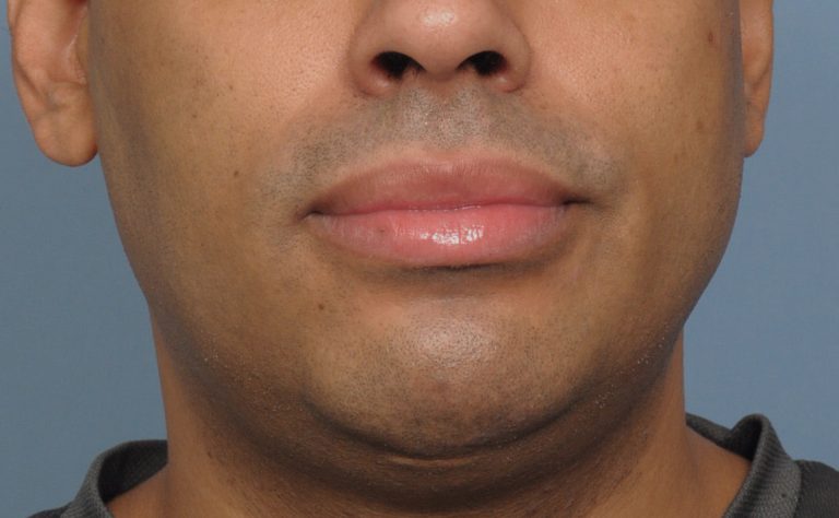 Plastic Surgery Case Study - An Autologous-Implant Approach to Jawline ...