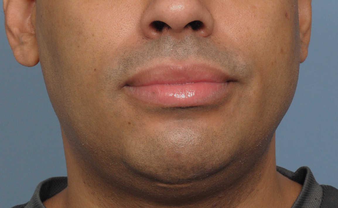 male lower faciao deficiency front 1 Dr Barry Eppley Indianapolis ...