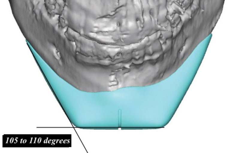 Design Considerations in Square Chin Implants - Explore Plastic Surgery