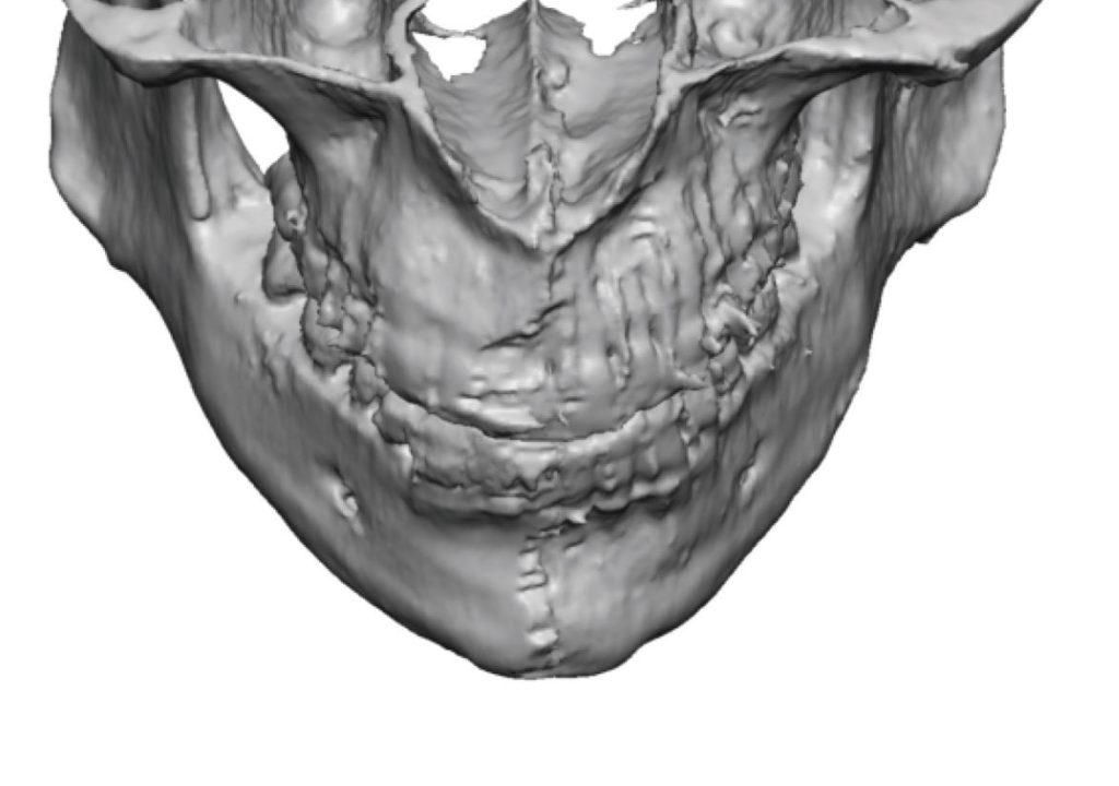 Design Considerations in Square Chin Implants - Explore Plastic Surgery