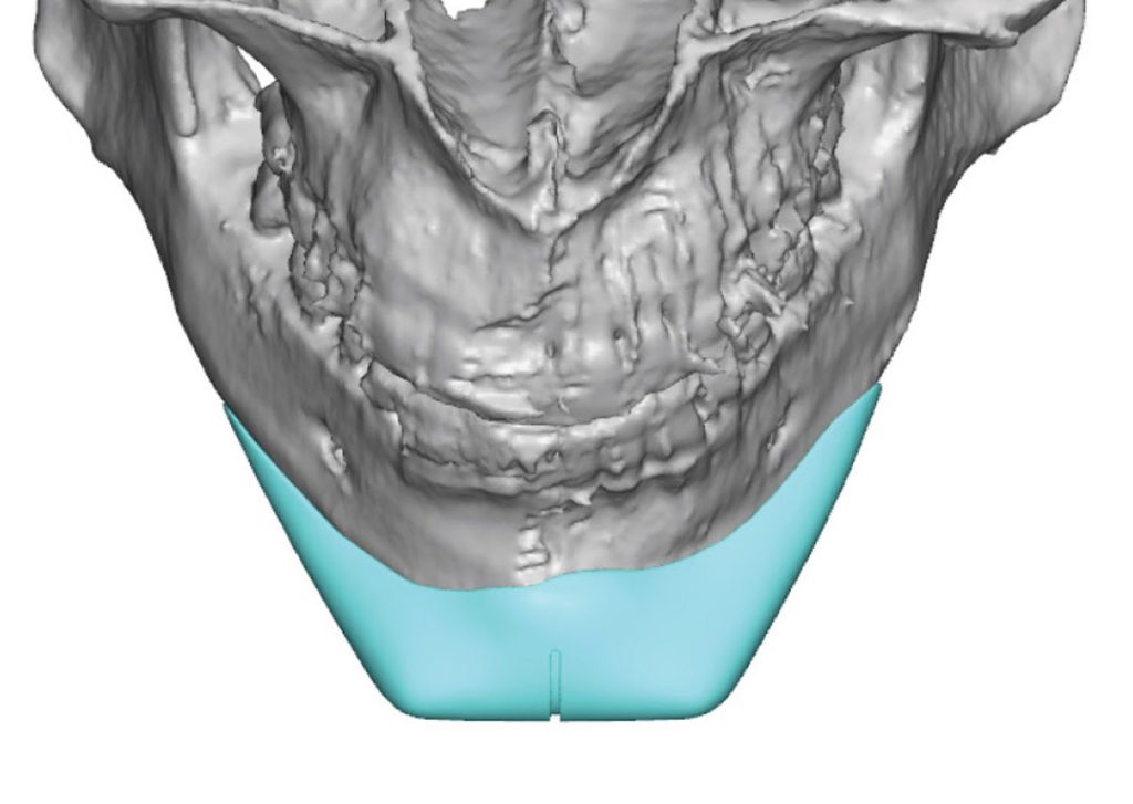 Design Considerations in Square Chin Implants - Explore Plastic Surgery