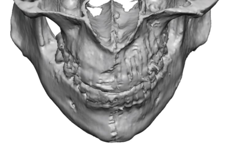 Design Considerations in Square Chin Implants - Explore Plastic Surgery