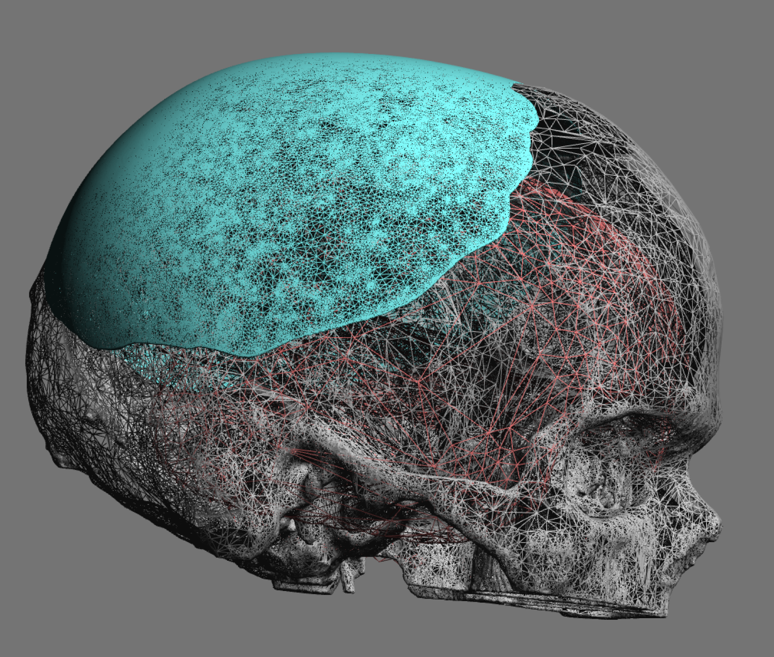 Custom Skull Implant Designs to Treat The Posteriorly Dominant Narrow ...
