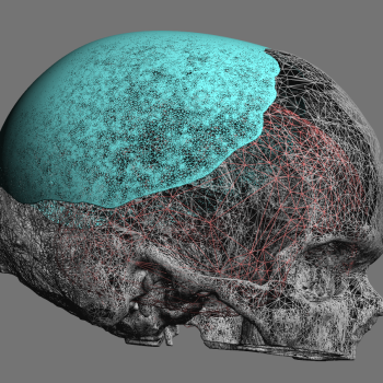skull reshaping Archives - Page 2 of 36 - Explore Plastic Surgery