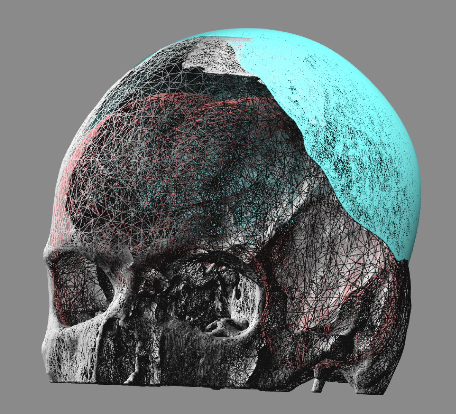 Custom Skull Implant Designs to Treat The Posteriorly Dominant Narrow ...