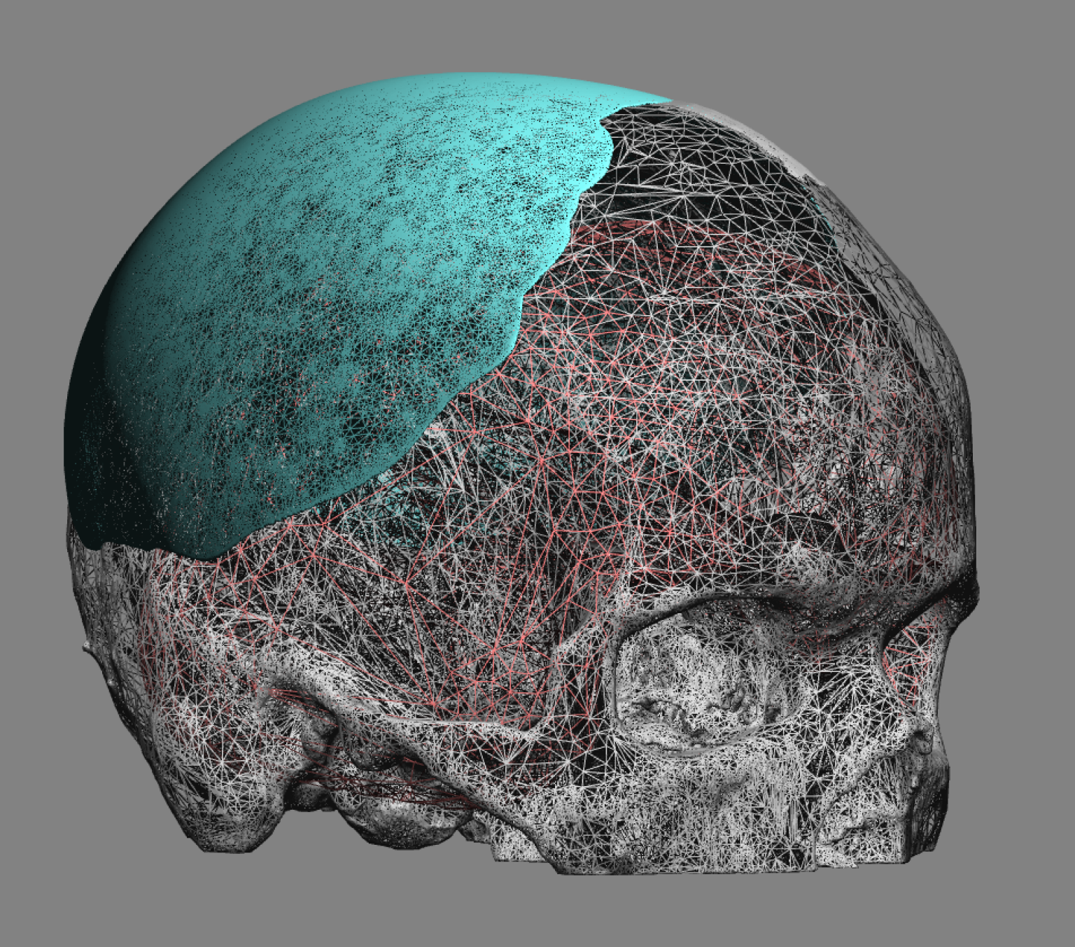 Custom Skull Implant Designs to Treat The Posteriorly Dominant Narrow ...
