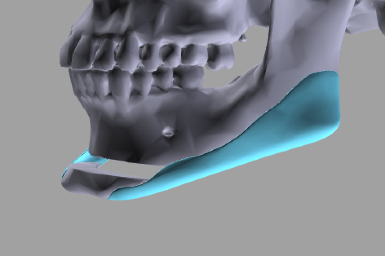 Plastic Surgery Case Study - An Autologous-Implant Approach to Jawline ...