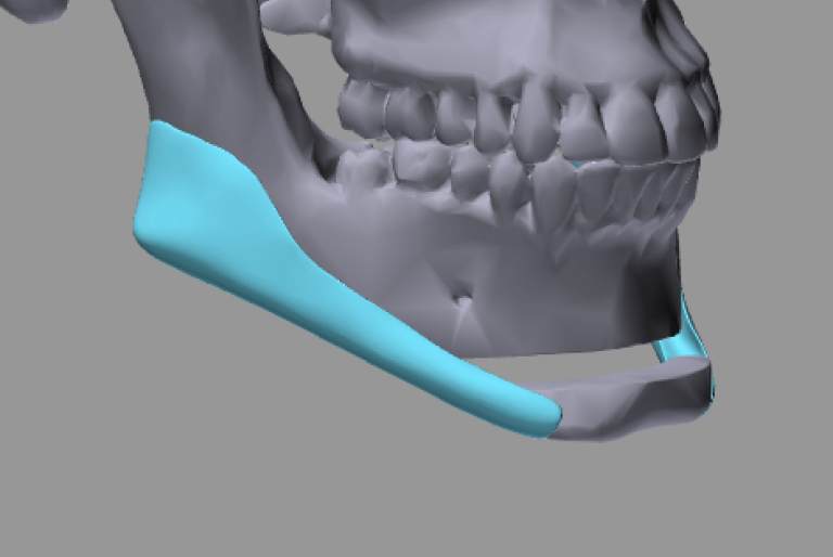 Plastic Surgery Case Study - An Autologous-Implant Approach to Jawline ...