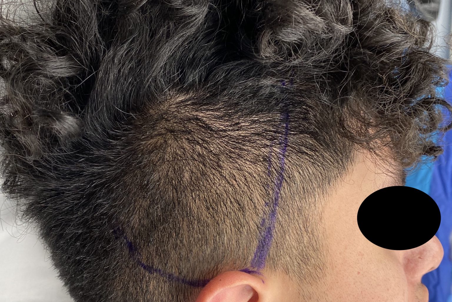 Common Misconceptions of Temporal Reduction Surgery - Explore Plastic ...