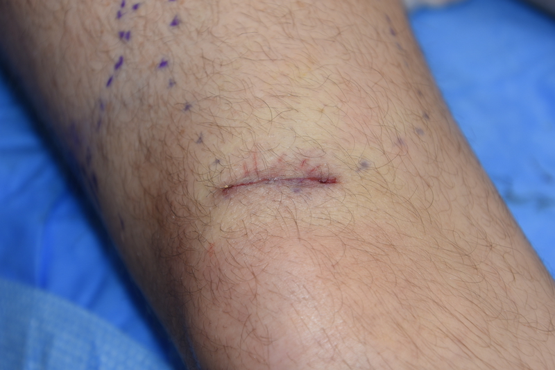 Outcome for Aesthetic Upper Leg Augmentation with Four (4) Thigh ...
