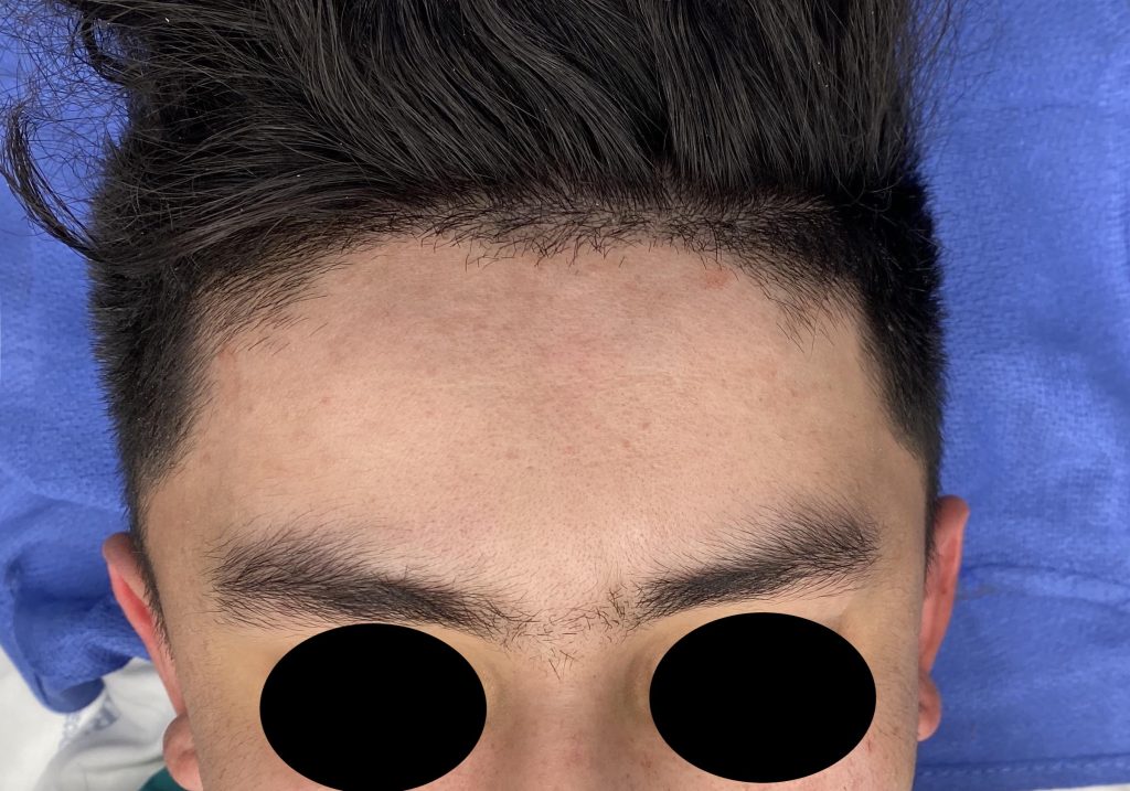 young male temporal reduction result intraop DR Barry Eppley ...