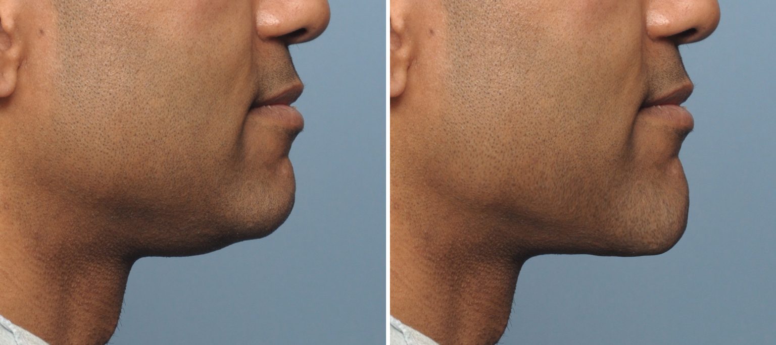 Plastic Surgery Case Study - Multi-Level Facial Masculinization Using ...