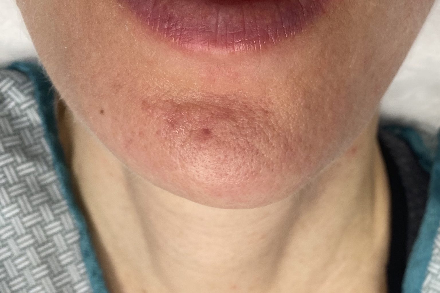 Plastic Surgery Case Study - Asymmetric Custom Chin Implant for Soft ...