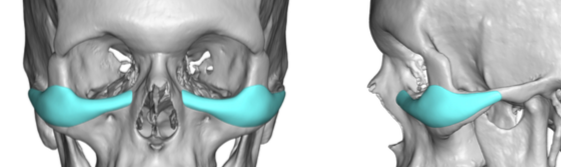 Technical Strategies - Placement of Custom Infraorbital-Malar Implants ...