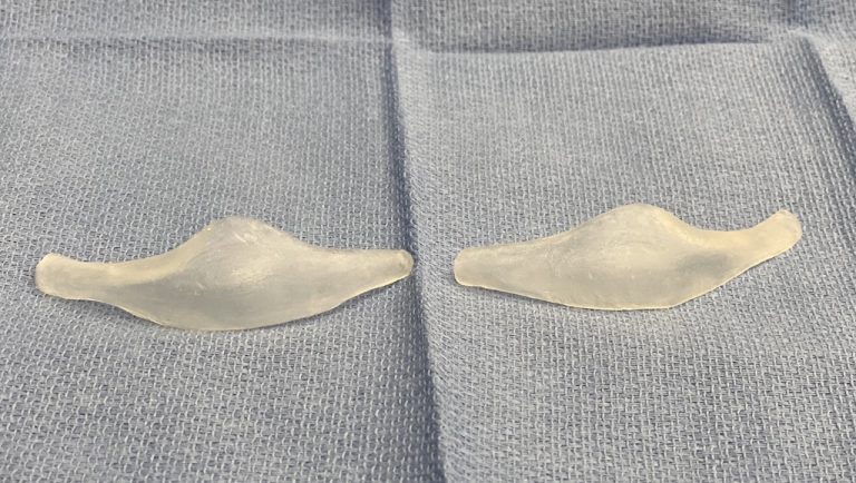 Technical Strategies - Placement of Custom Infraorbital-Malar Implants ...