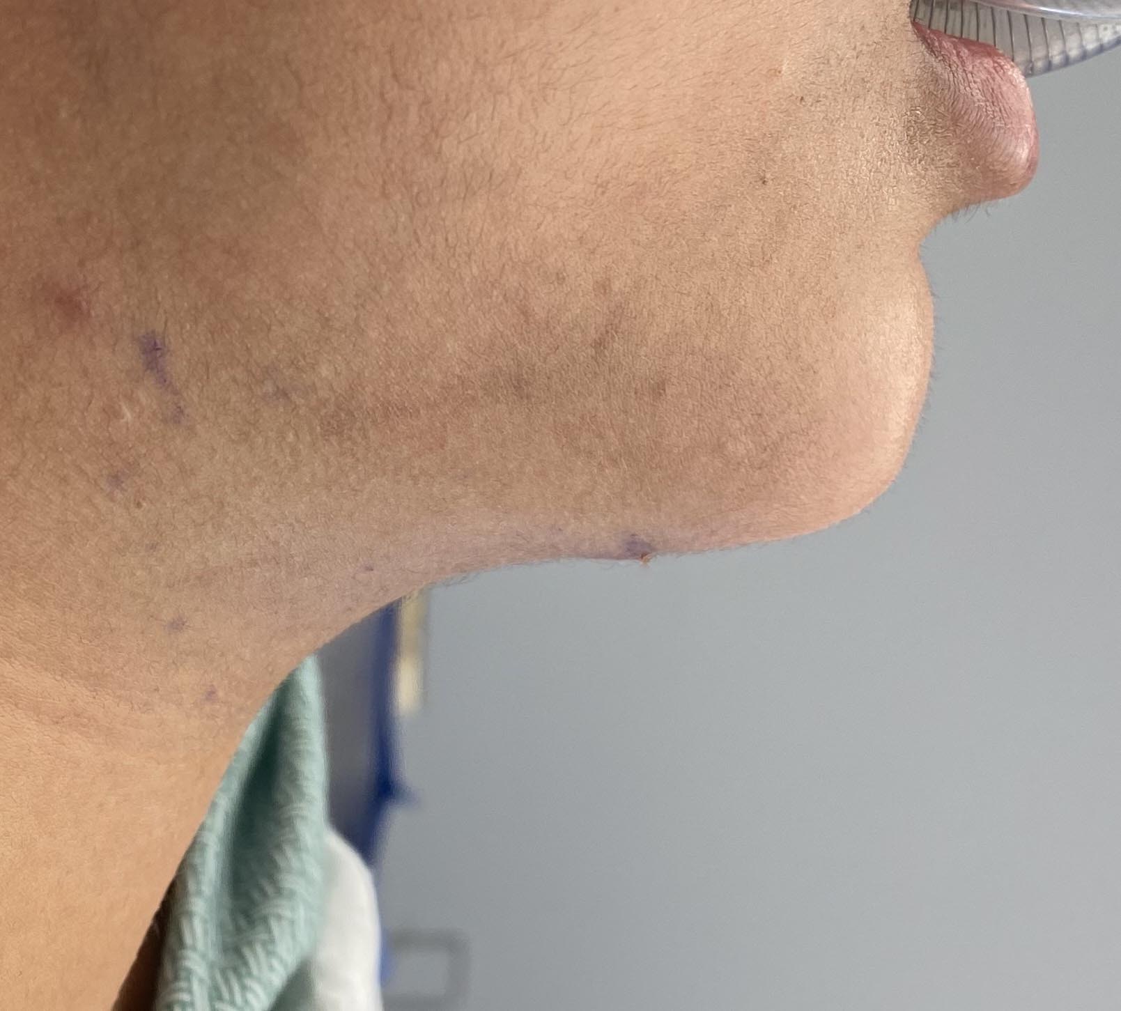 Plastic Surgery Case Study - Correction of Dynamic Chin Ptosis in the ...