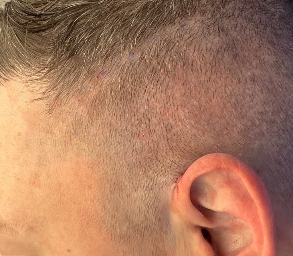 Plastic Surgery Case Study - Temporal Muscle Reduction/Transposition ...