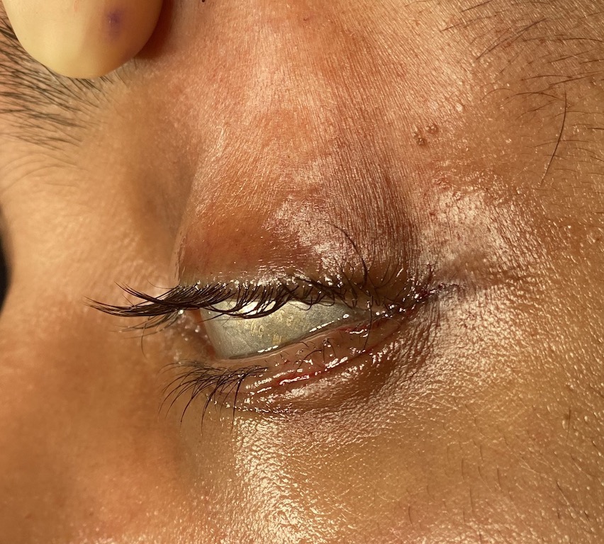 Technical Strategies - Placement of Custom Infraorbital-Malar Implants ...