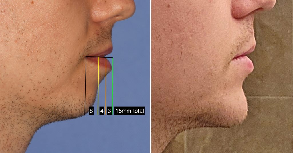 Plastic Surgery Case Study - Male 3 Stage Chin Augmentation Journey ...