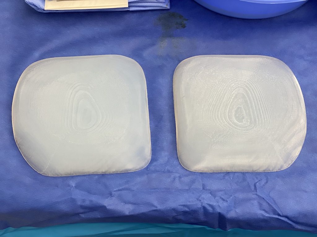 Plastic Surgery Case Study - Custom XL Pectoral Implants in the Male ...