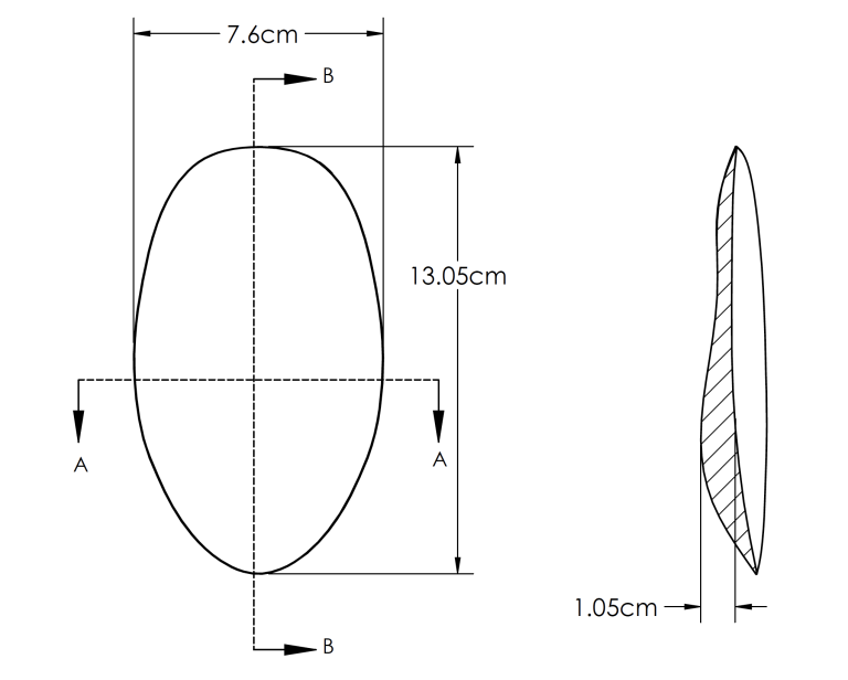 Plastic Surgery Case Study - Secondary Sternoplasty with Custom Sternal ...