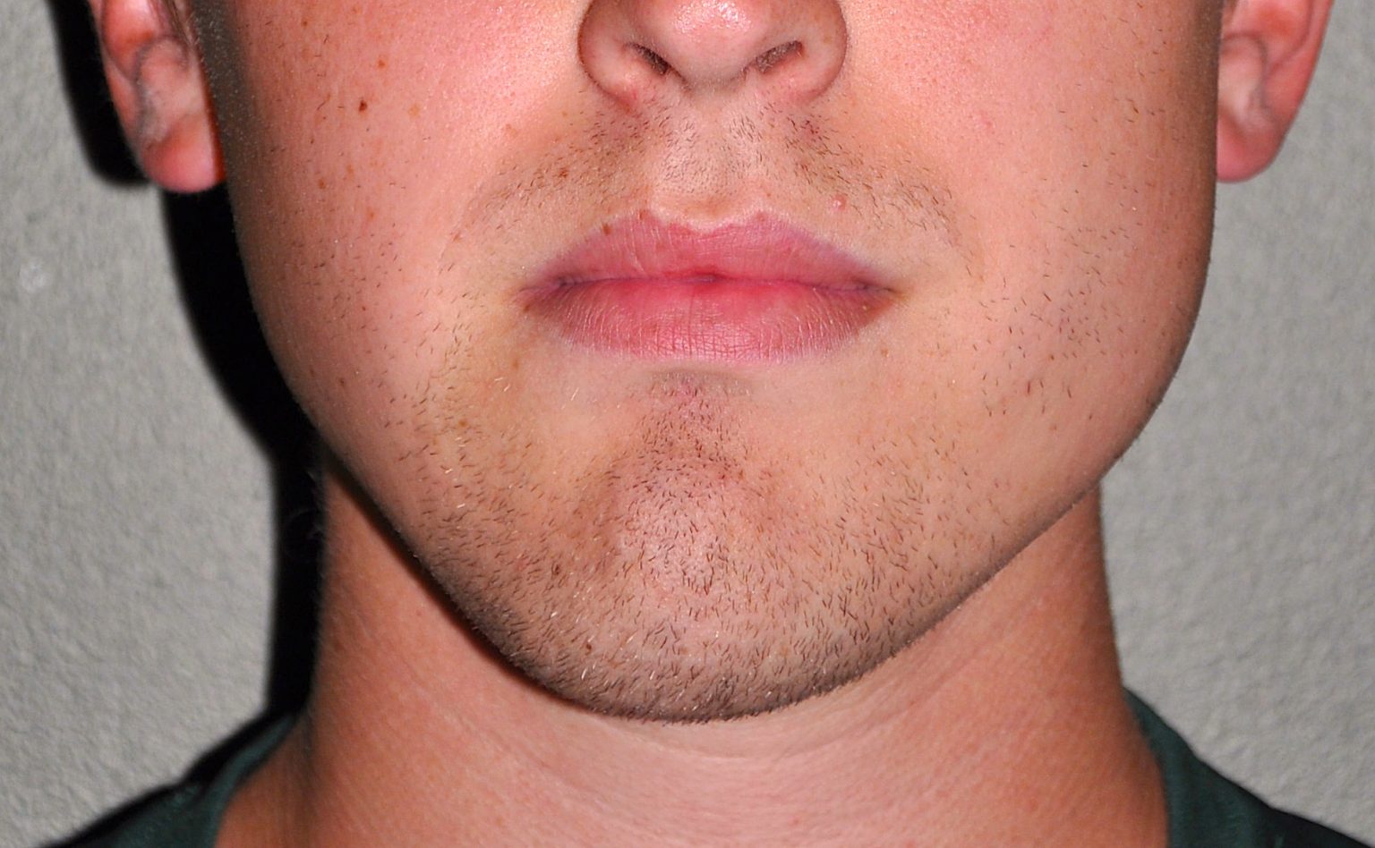 male right jaw asymmetry front 1 Dr Barry Eppley Indianapolis - Explore ...