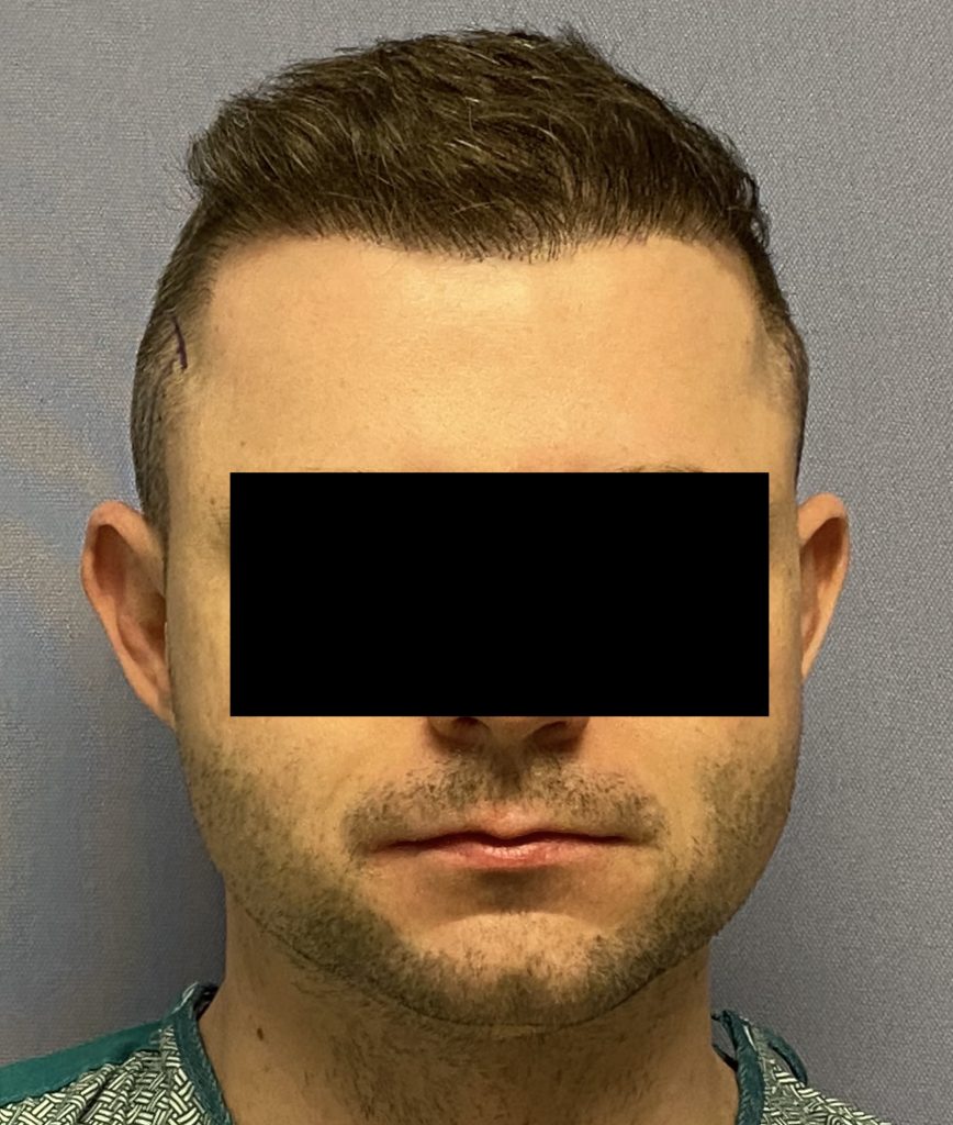 Plastic Surgery Case Study - Temporal Muscle Reduction/Transposition ...