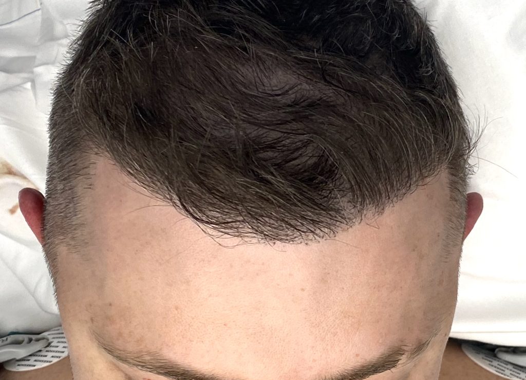 Plastic Surgery Case Study - Temporal Muscle Reduction/Transposition ...