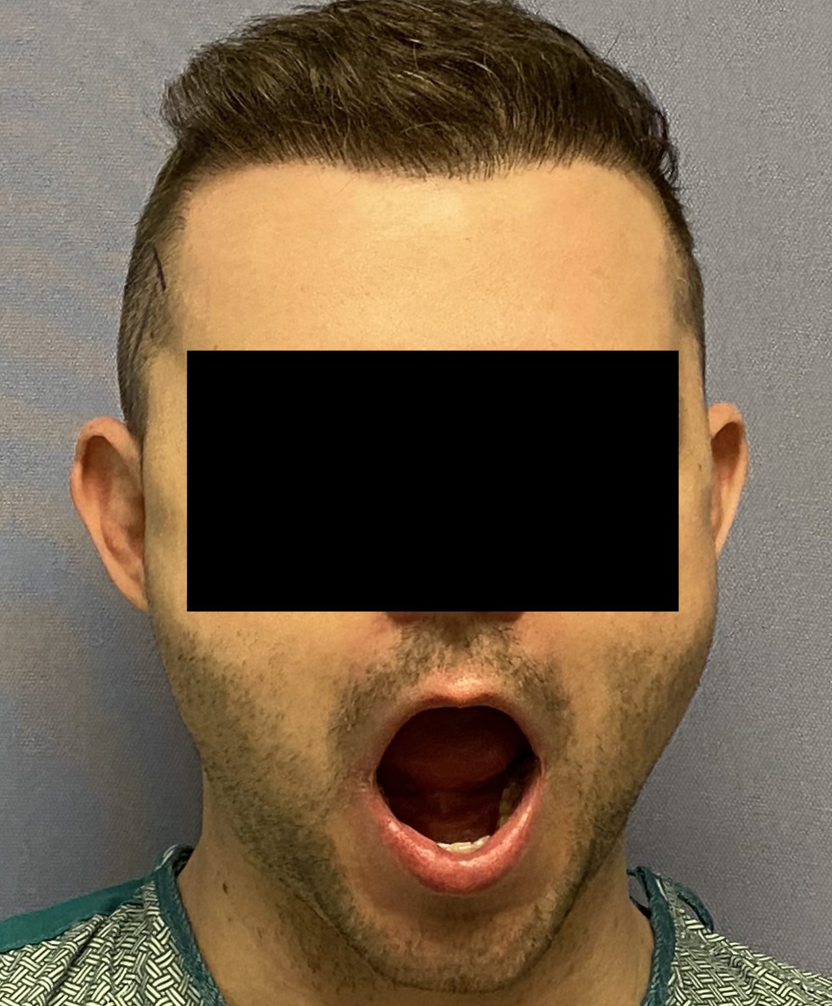 Plastic Surgery Case Study - Temporal Muscle Reduction/Transposition ...