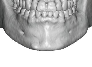 The 3D Bony Anatomy of Chin Clefts and Dimples - Explore Plastic Surgery