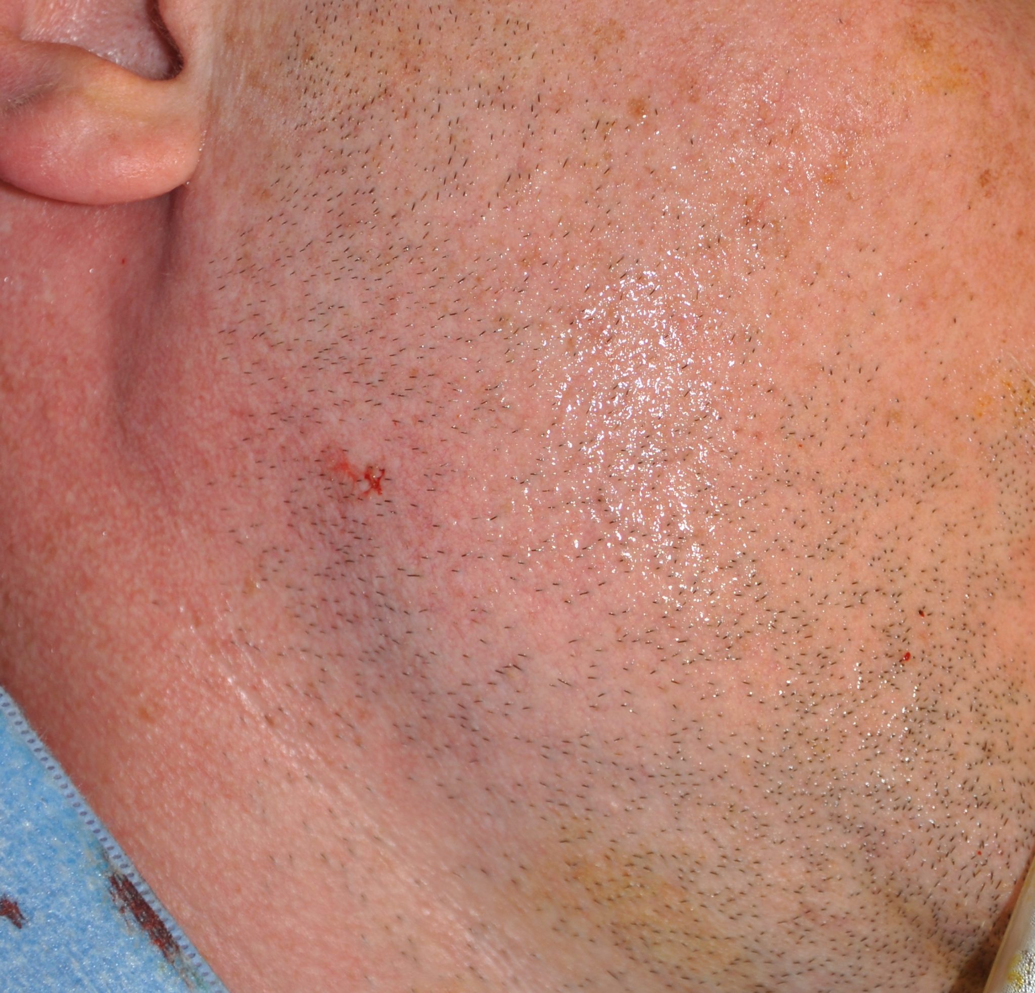 Percutaneous Jaw Angle Implant Screw Fixation Dr Barry Eppley