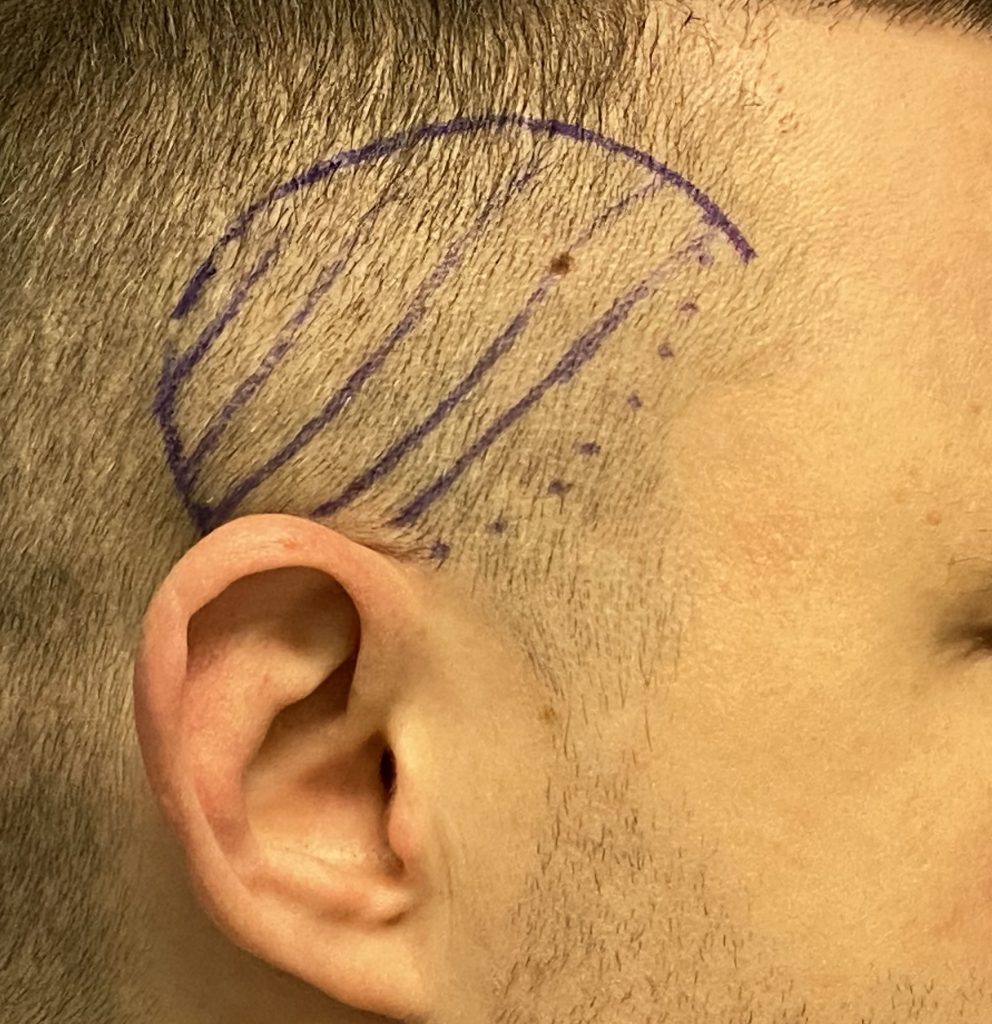 Plastic Surgery Case Study - Temporal Muscle Reduction/Transposition ...