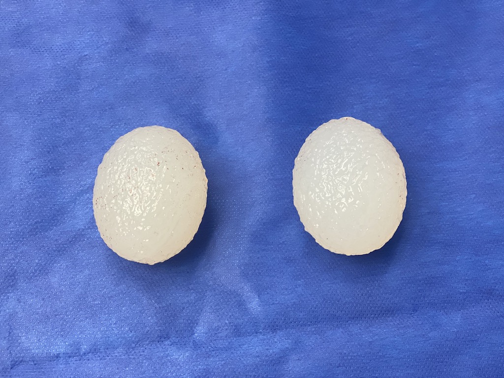 Textured Silicone Testicle Implant Removals Dr Barry Eppley