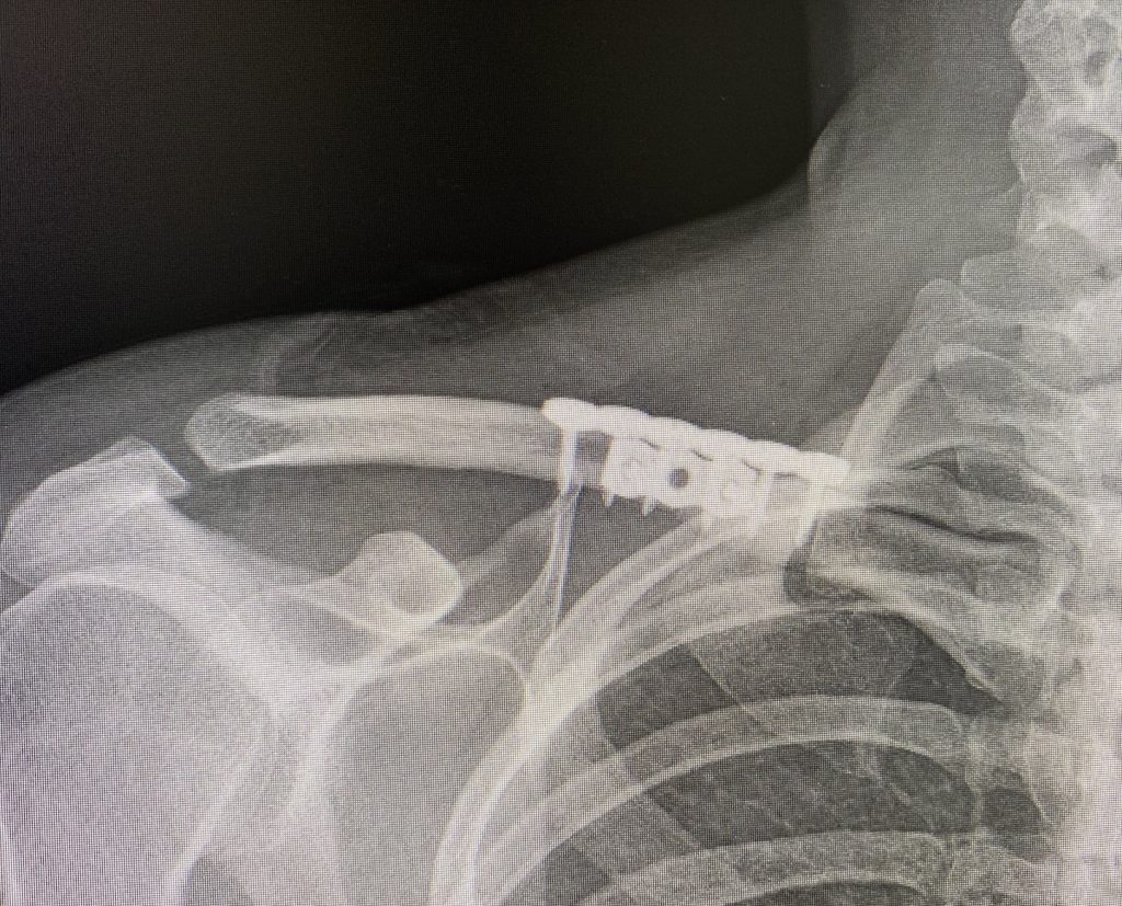 3 week postoperatve x-ray right shoulder reduction Dr Barry Eppley ...