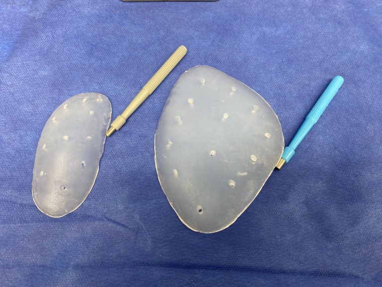 Plastic Surgery Case Study - Custom Deltoid Implants for Shoulder ...