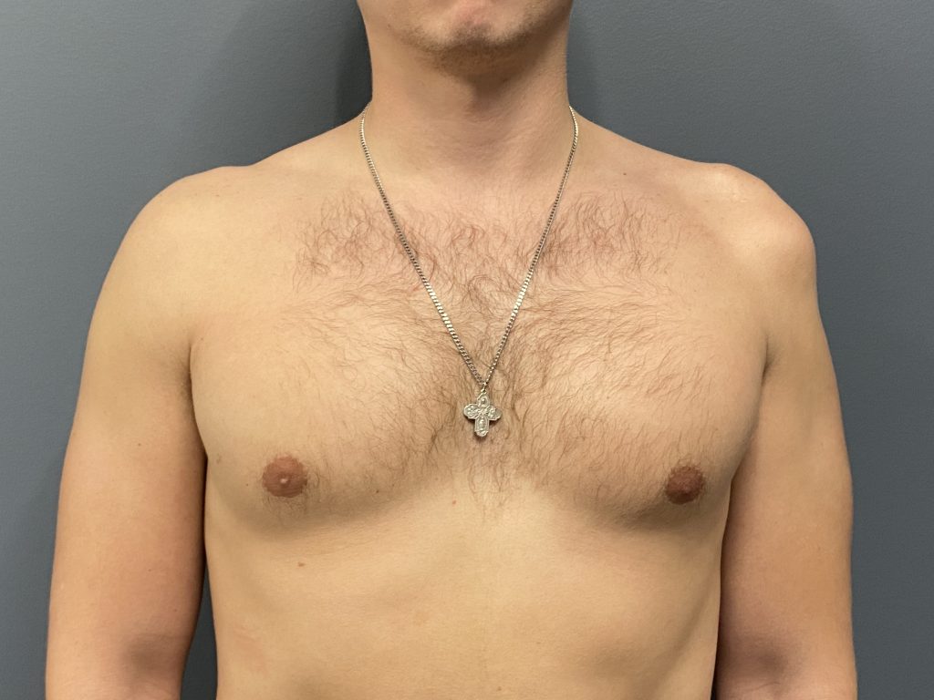 Plastic Surgery Case Study - Custom Deltoid Implants for Shoulder ...