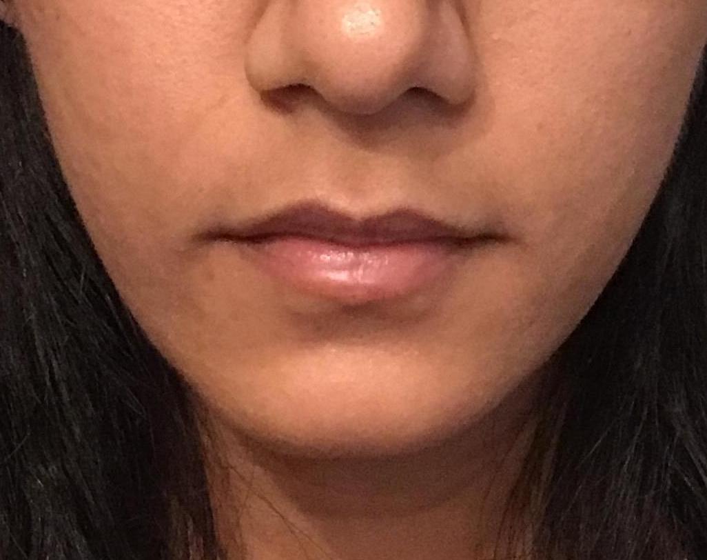 Plastic Surgery Case Study - The Vertical Wedge Reduction Sliding ...