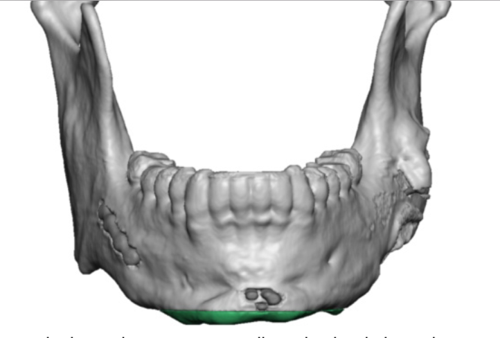 Plastic Surgery Case Study - Submental Inferior Border Shave and Custom ...