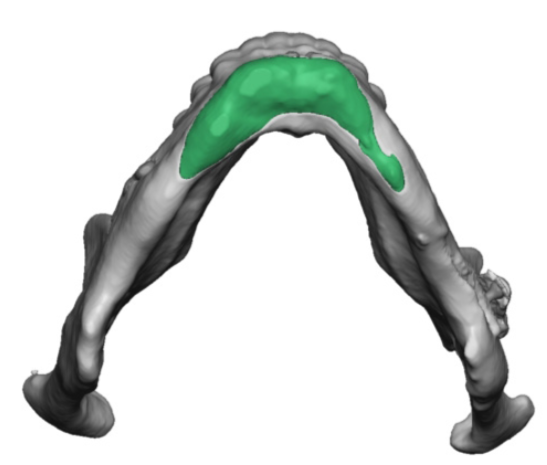 Plastic Surgery Case Study - Submental Inferior Border Shave and Custom ...
