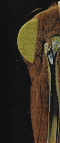 large custom buttocl implants 3D CT scan right side view Dr Barry ...