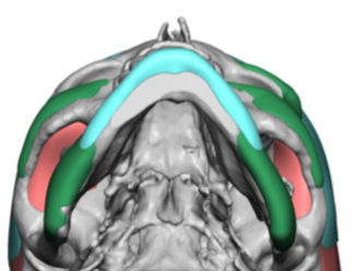 Plastic Surgery Case Study - Submental Inferior Border Shave and Custom ...