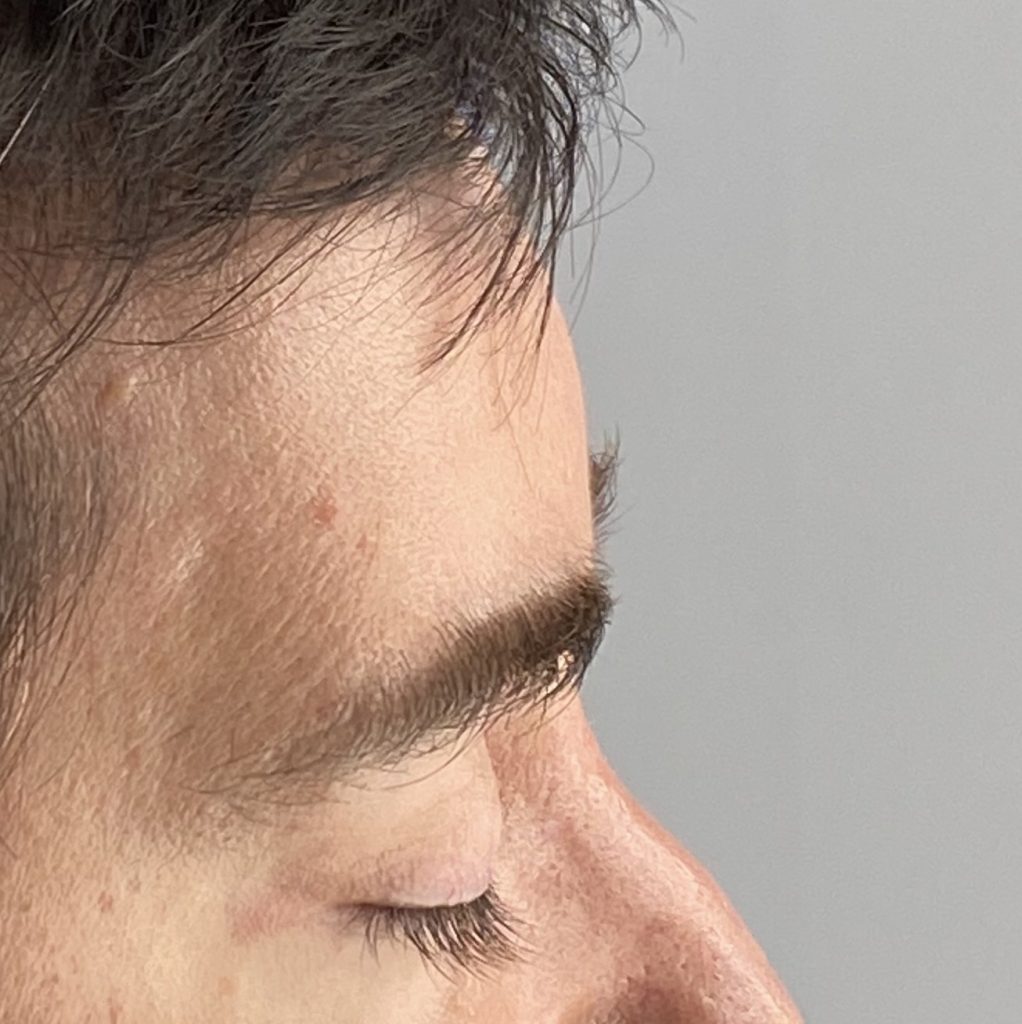 Plastic Surgery Case Study - Custom Forehead Implants for Reducing The ...