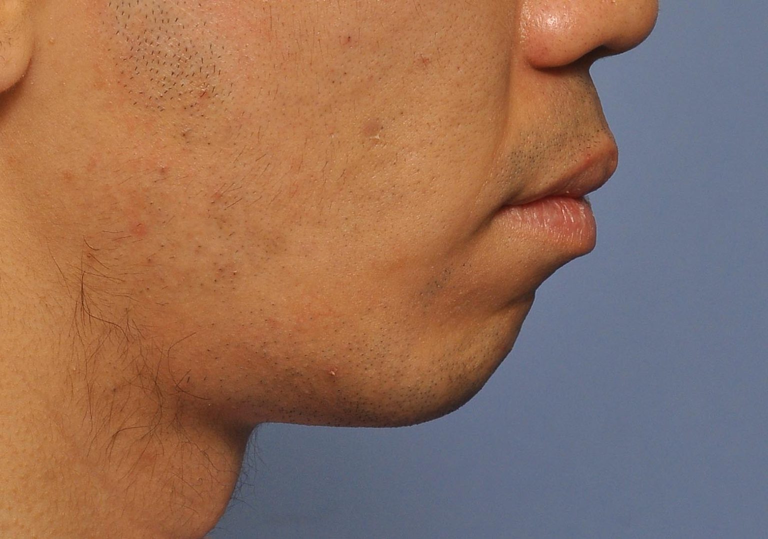 Plastic Surgery Case Study - Preoperative Labiomental Fold Shape and ...