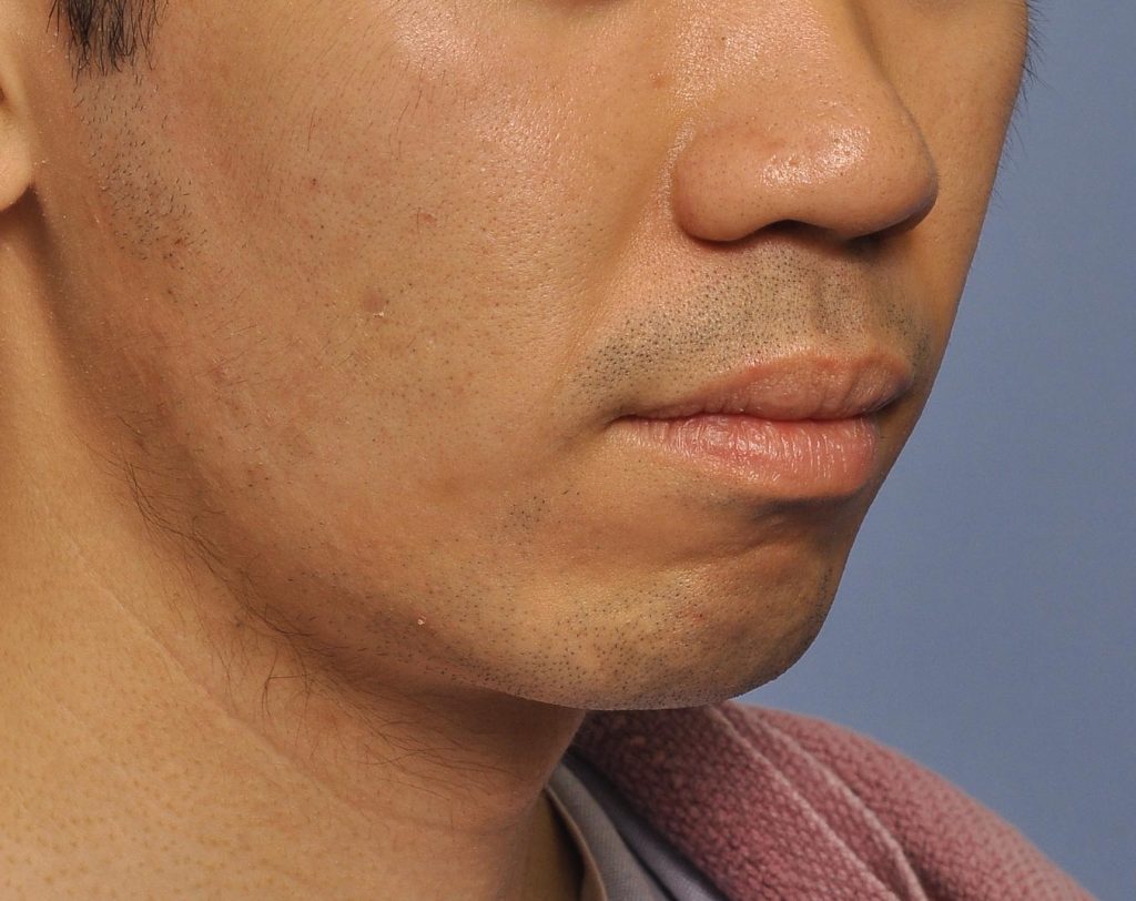 Plastic Surgery Case Study - Preoperative Labiomental Fold Shape and ...